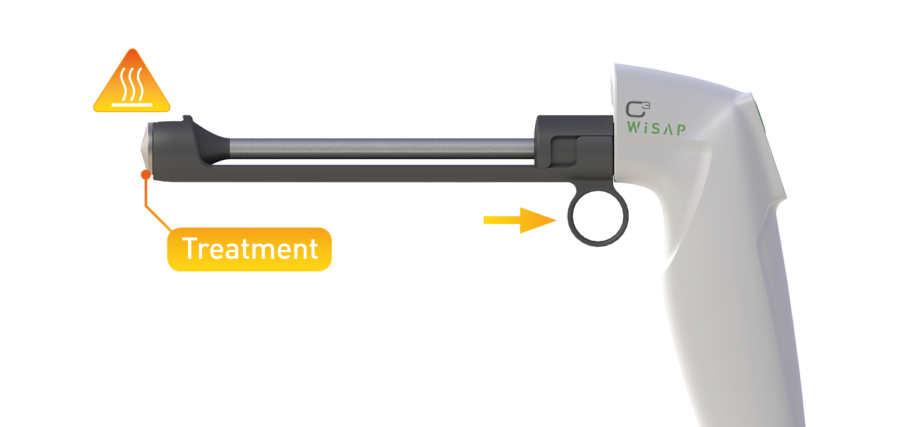 WISAP-C3-Coagulator-Treat - Thermo Coagulation